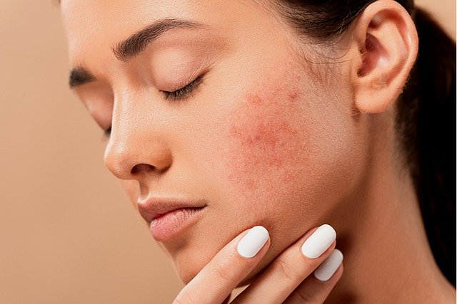 Pimple Positivity - The Rise of Acne Positivity Movement – Carmesi